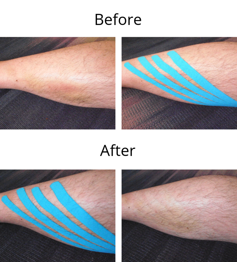 New Therapy Modality - Kinesiology Taping - Massage and Movement